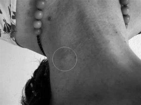 Enlarged Right Epitrochlear Lymph Node