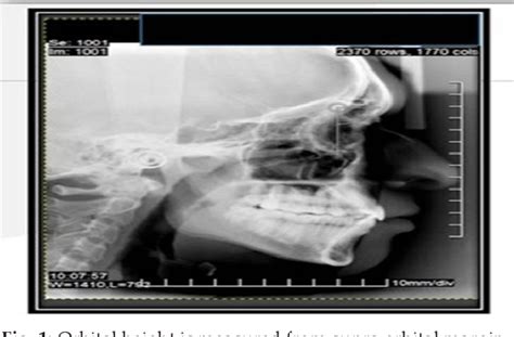 Figure 2 From Sex Determination In Kerala Population Using Morphometric Analysis Of Orbital And