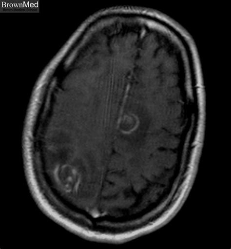 Toxoplasmosis Brain