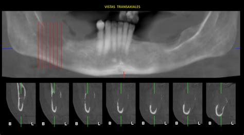 Caso Nº605 Neoplasia Maligna Mandibular Cdi