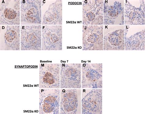 Ihc For Podocyte Specific Proteins Nephrin Podocin And Synaptopodin Download Scientific
