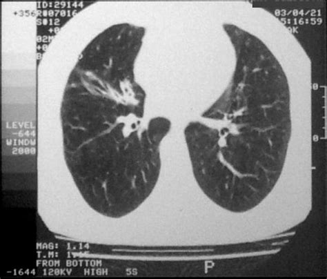 Bronchiectasis On Both Lower Lobes Of Lungs With Computerized Tomography Download Scientific