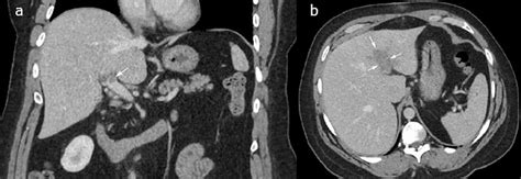 Elizabeth Lorbeer On Linkedin Prothrombin Gene Mutation As A Teaching