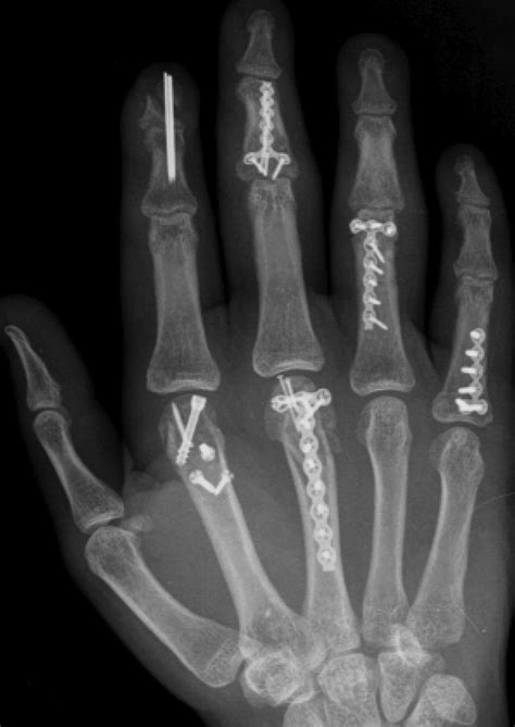 Wrist Fracture Open Reduction And Internal Or Externa