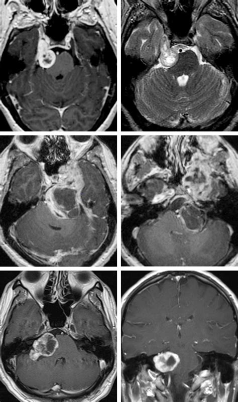 Trigeminal Impression