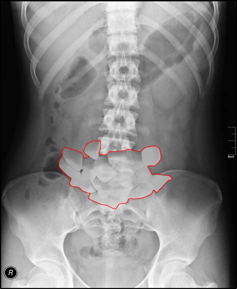 Man Finds Surprise In Stomach After Trip To Ireland Radiology Medical Radiography X Ray