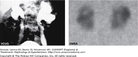 Reflux Nephropathy Abdominal Key