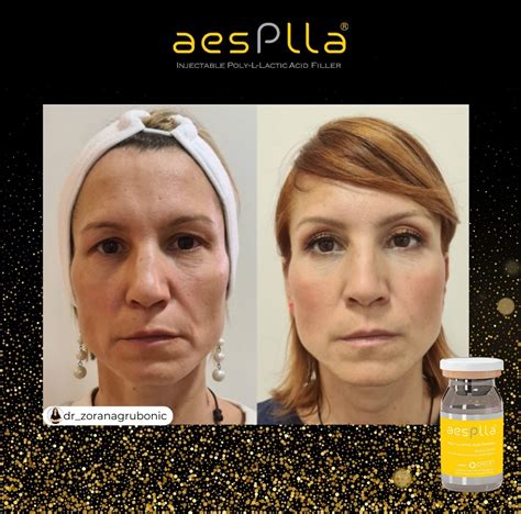 Cara Membuat Pipi Tembem Alami Dengan Cepat St Indonesia