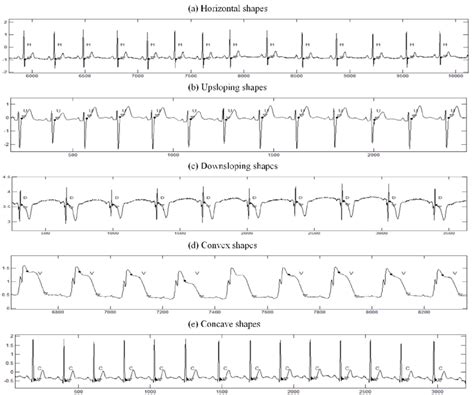 The Result Of The St Shape Classification By The Proposed Algorithm Download Scientific