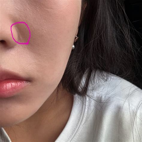 코 옆 저렇게 된 거 어떻게 해야 하나요 ㅠㅠ 지식in