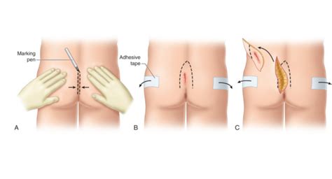 Pilonidal Disease Dr Diego Marines