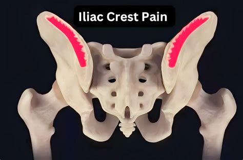 Iliac Crest Pain Relieve Iliac Crest Pain 2024