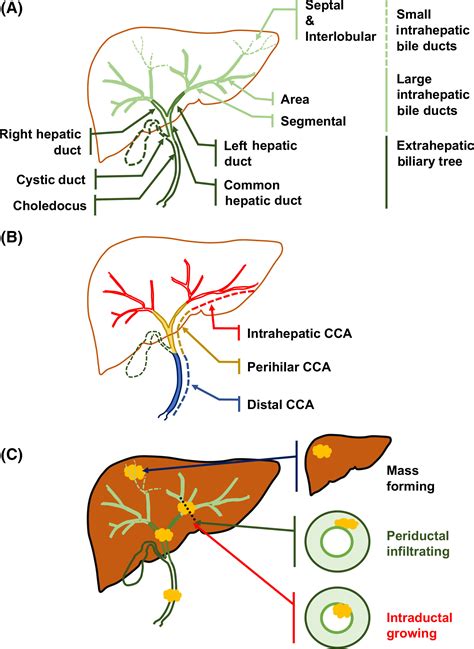 Cholangiocarcinoma Diagram