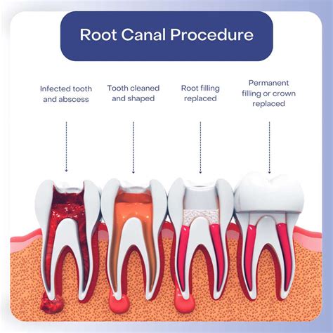 Best Root Canal Treatment In Mumbai Opus Dental Specialities