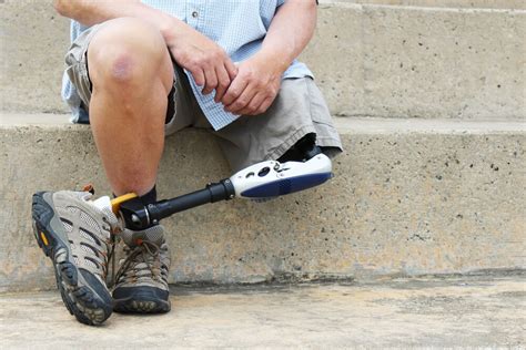 Nj Amputation And Dismemberment Lawyer Free Consultation