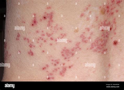 Shingles Rash Red On The Back Of A 72 Year Old Woman Also Known As