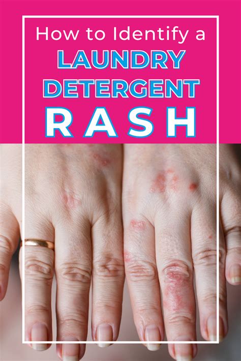 Laundry Detergent That Causes Skin Rash Bsbf