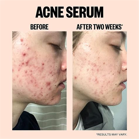 Peace Out Salicylic Acid Acne Treatment Serum 30 Ml Beautique