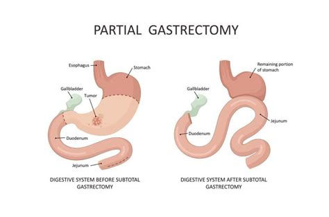 Stomach Cancer Symptoms Causes And Treatment Nexus Surgical