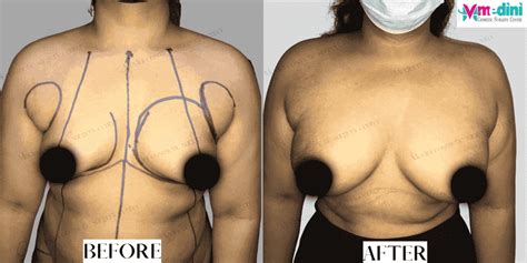 Best Boob Job Before And After Image 100 Safe And Secure