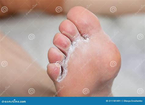 The Diseased Foot With Hyperhidrosis Is Sprinkled With Talcum Powder