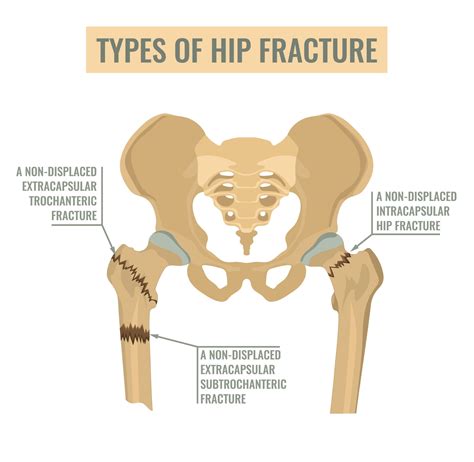 Hip Fracture Types Surgery To Repair A Hip Fracture Learning About