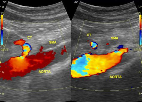 Superior Mesenteric Vein Ultrasound