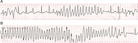 A Polymorphic Ventricular Tachycardia With Preceding Prolonged Qt Download Scientific Diagram