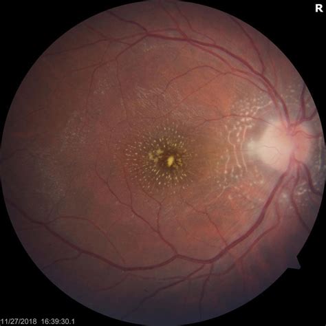 Neuroretinitis Ento Key