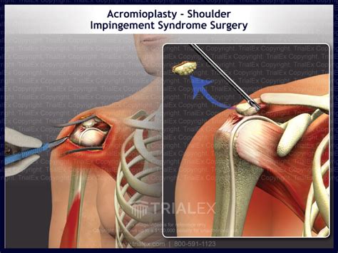 Acromioplasty Shoulder Impingement Syndrome Surgery Trialquest