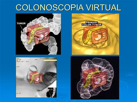CUANDO SOSPECHAR UN CANCER DE COLON - ppt video online descargar