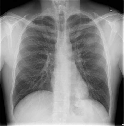 Chest X Ray Pneumonia