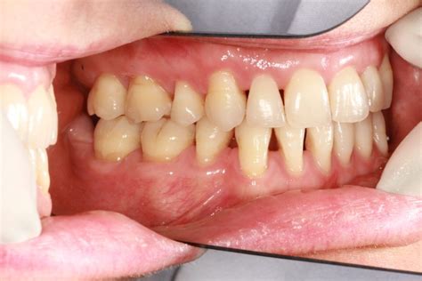 What Are Those Black Triangle Shaped Spaces Between My Teeth