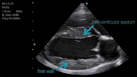 Dilated Cardiomyopathy Echo