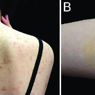 Clinical Photography A Diffuse Pink To Brown Macules With Crusts And Download Scientific