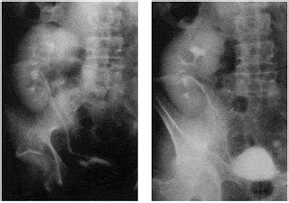 Imágen Lateral De Rx De Persona Con Doble J