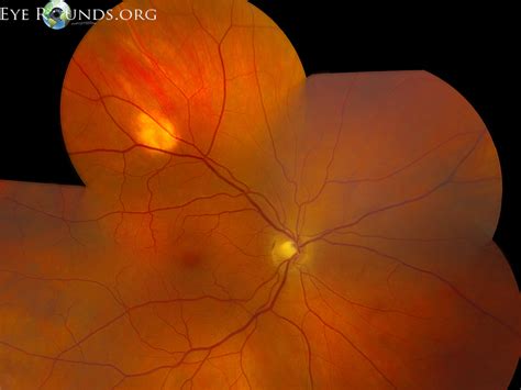 Atlas Entry Idiopathic Sclerochoroidal Calcification