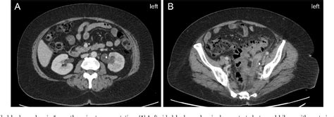 Figure 1 From Necrotizing Fasciitis From Perforated Sigmoid Diverticulitis With Subsequent