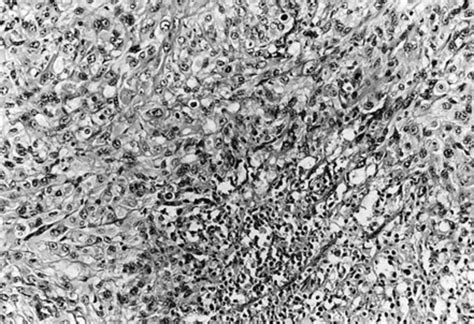 Proximal Type Epithelioid Sarcoma Of The Back Case 7 Shows A Download Scientific Diagram