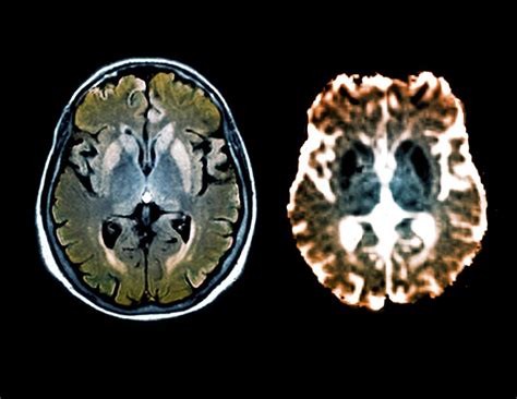 Creutzfeldt Jakob Disease Effects At Hudson Becher Blog