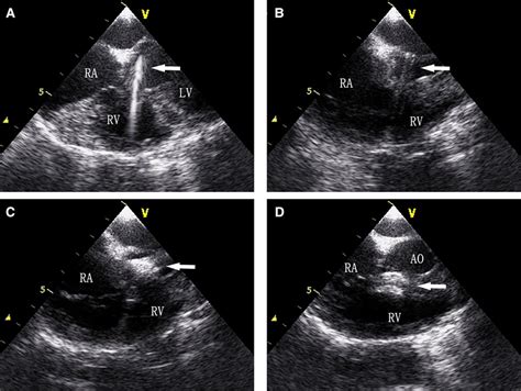 Frontiers Transthoracic Device Closure Of Perimembranous Ventricular Septal Defect Via A Small