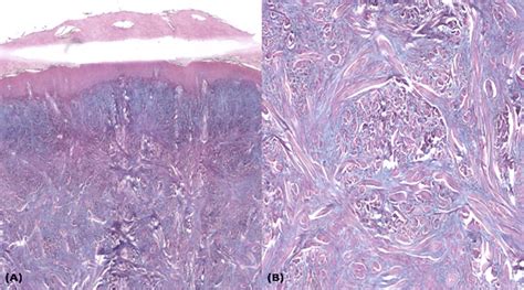 Pathology Images Superficial And Deep Fibrosing Dermatitis With