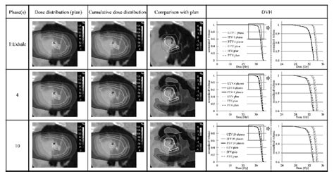 Cumulative Dose Distribution And Comparison With Plan In Patient 1 Download Scientific Diagram