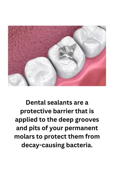 Dental Sealants Oc Graceful Smiles