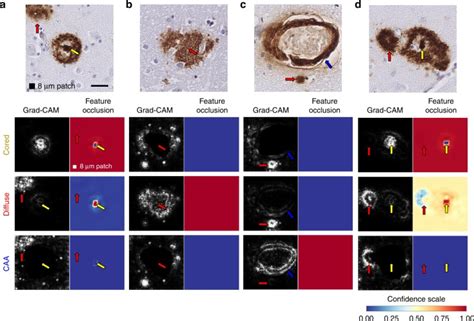 Interpretable Classification Of Alzheimers Disease Pathologies With A