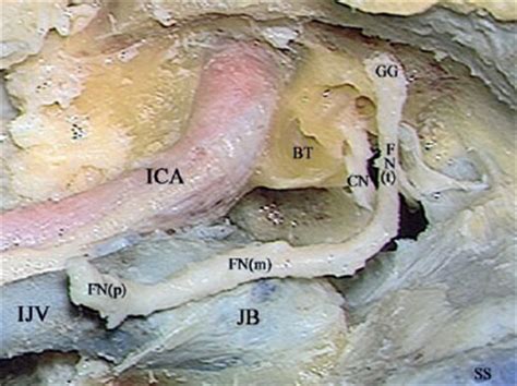Anatomy Of The Temporal Bone Ento Key