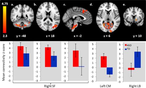 Areas Of Abnormal Intrinsic Functional Connectivity In Asd Panels Ac