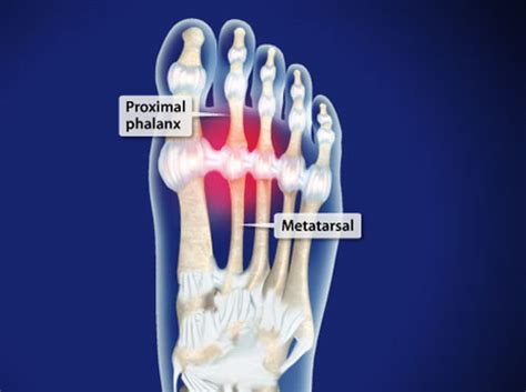 Video Mtp Synovitis Capsulitis Healthclips Online