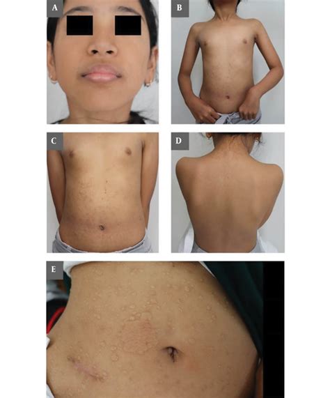 Primary Anetoderma In An Infant A Case Report From Southeast Asia Primary Anetoderma In An Infant A Case Report From Southeast Asia