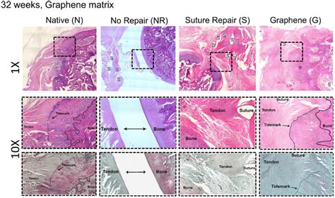 muscle degeneration in chronic massive rotator cuff tears of the